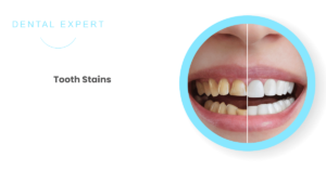 Tooth Stains: Everything Need to Know About Them